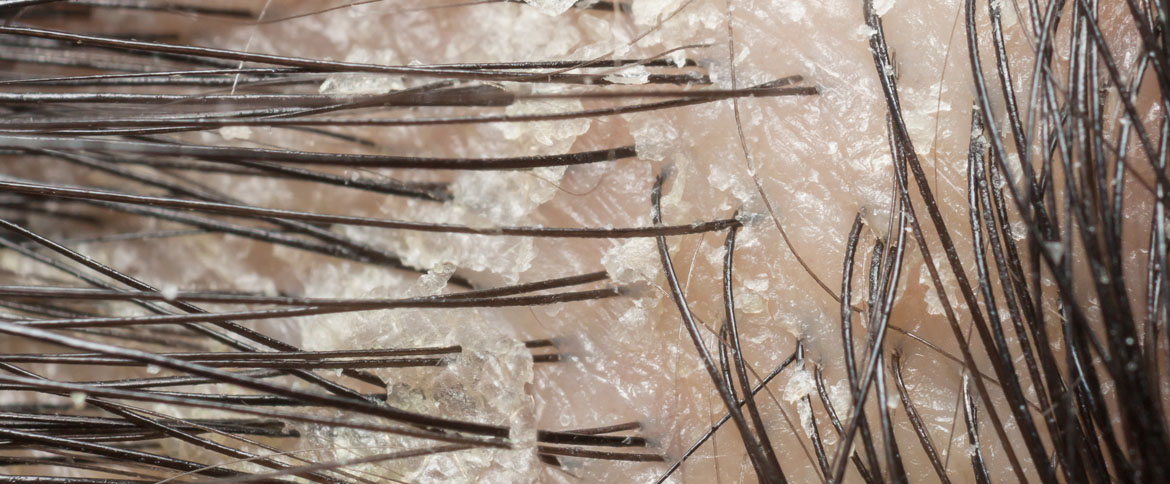 MESOTERAPIA CAPILAR en Valencia | Ponle freno a la pérdida capilar