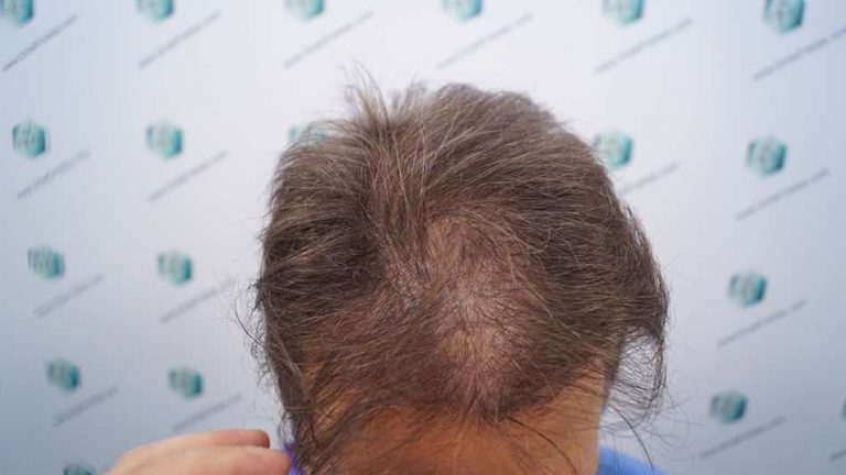 Alopecia Difusa DPA Con Patrón | Clínica de Freitas