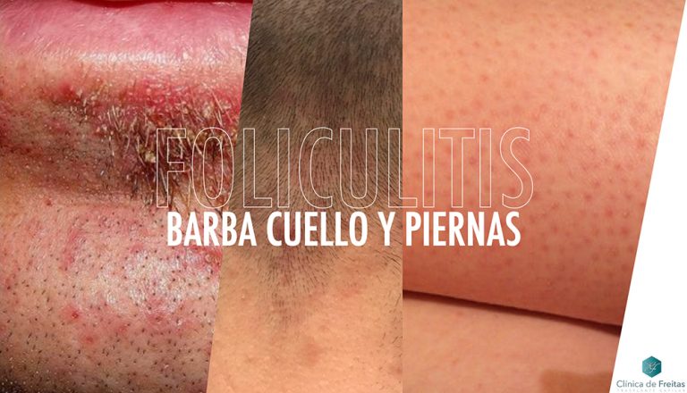 ¿Qué es la pseudofoliculitis y como tratarla?