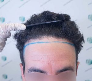 ¿Cómo conseguir una línea frontal de cabello natural?